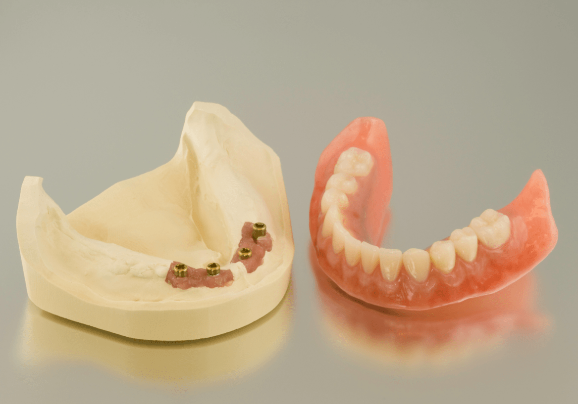 Dental Implant Dentures Chermside - Snap On Dentures Brisbane