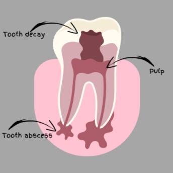 Tooth Abscess - Q&A by Dr David Kerr | Today's Dentistry