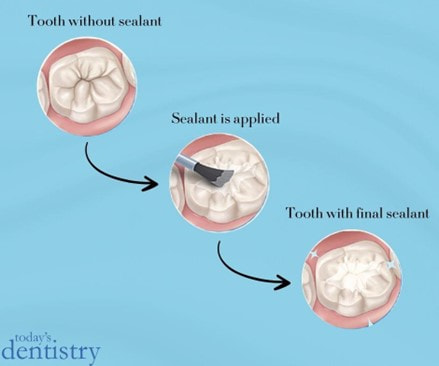 Protect Kids’ Teeth with Sealants & Tooth Fillings Brisbane